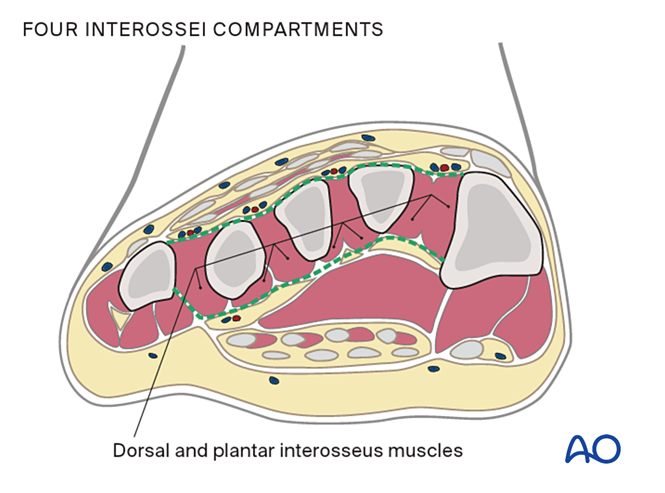 Compartment syndrome of the foot