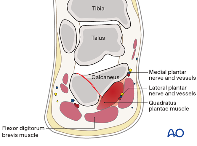 Compartment syndrome of the foot