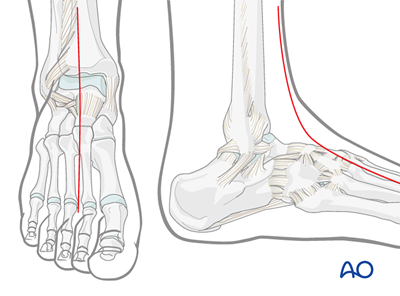 Compartment syndrome of the foot