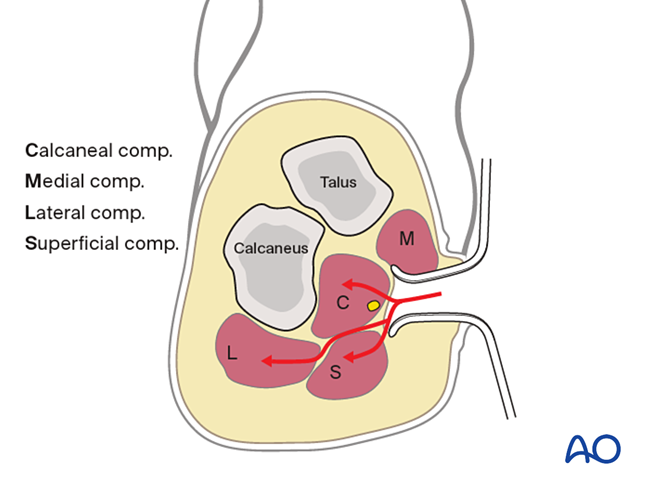 Compartment syndrome of the foot