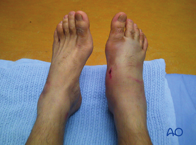 Cuboid avulsion fracture