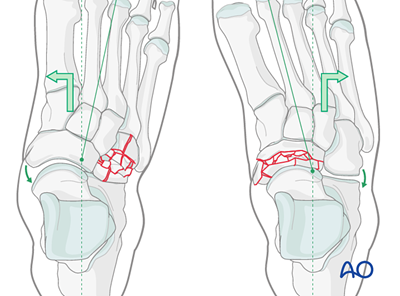 Treatment of Chopart injuries for Chopart injuries