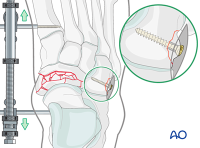 Treatment of Chopart injuries for Chopart injuries
