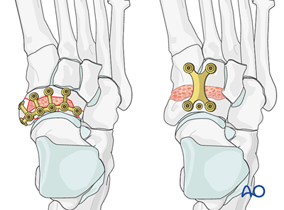 Treatment of Chopart injuries for Chopart injuries