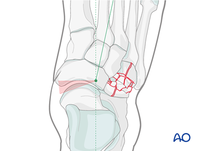 Treatment of Chopart injuries for Chopart injuries