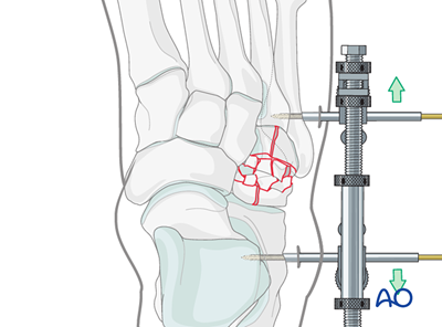 Treatment of Chopart injuries for Chopart injuries