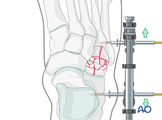 Treatment of Chopart injuries for Chopart injuries