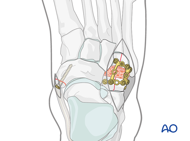 Treatment of Chopart injuries for Chopart injuries