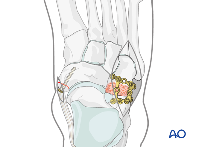 Treatment of Chopart injuries for Chopart injuries