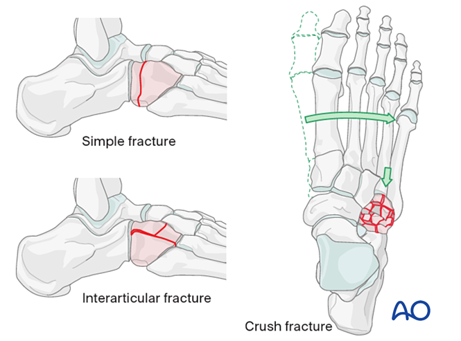Dorsolateral approach to the midfoot
