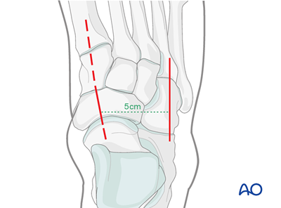 Medial utility incision to the midfoot