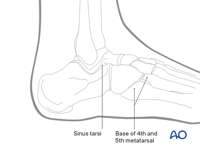 Dorsolateral approach to the midfoot