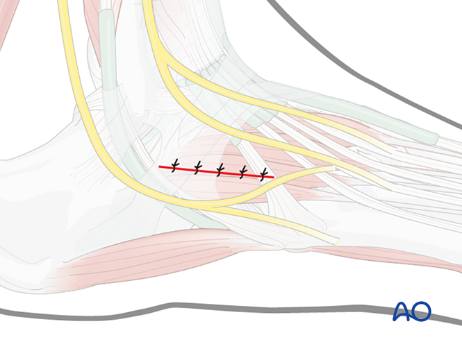 Dorsolateral approach to the midfoot