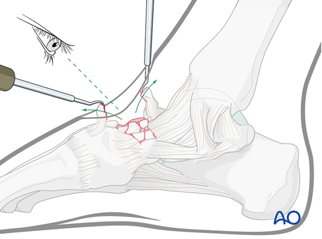 Dorsomedial approach to the midfoot