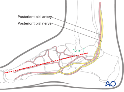 Percutaneous approach to the navicular