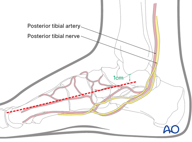 Percutaneous approach to the navicular
