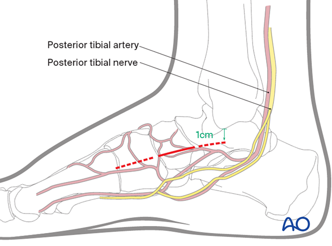 Medial utility incision to the midfoot