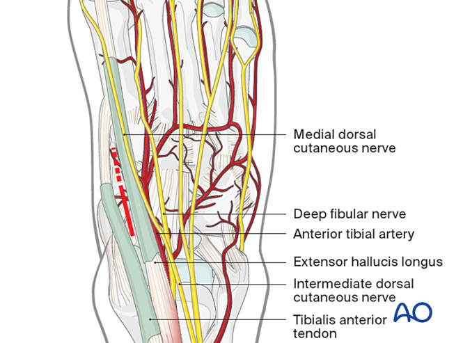 Medial utility incision to the midfoot