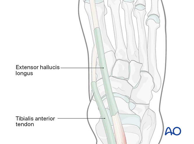 Percutaneous approach to the navicular