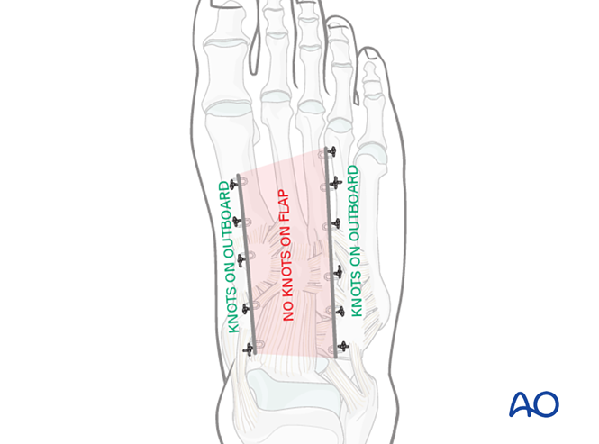 Percutaneous approach to the navicular