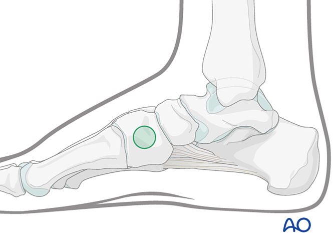 Safe zones for pin and K-wire insertion in the foot