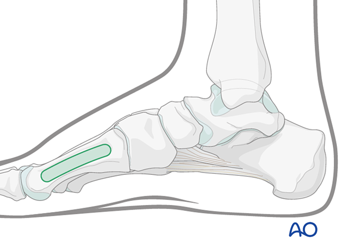 Safe zones for pin and K-wire insertion in the foot