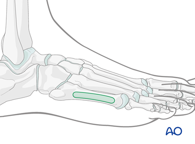 Safe zones for pin and K-wire insertion in the foot