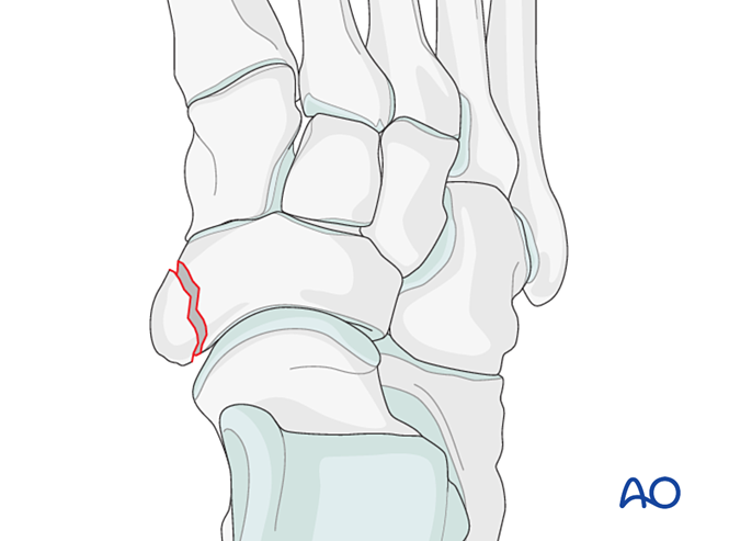 Navicular avulsion fracture