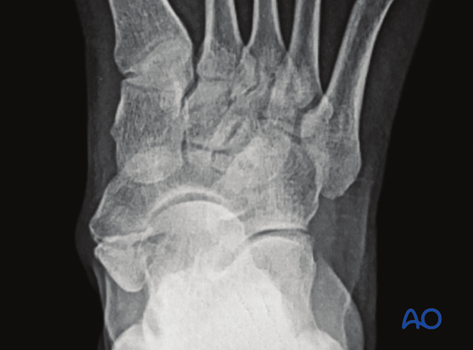 Navicular avulsion fracture