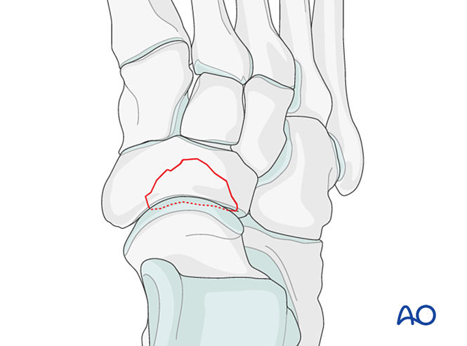 Partial articular navicular fracture