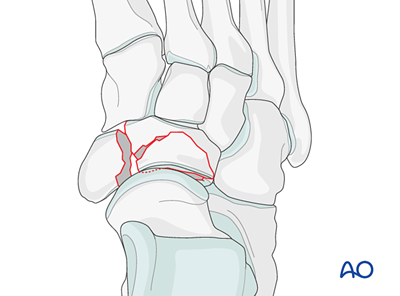 Complete articular navicular fracture