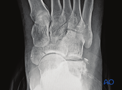 Complete articular navicular fracture
