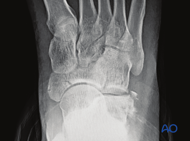Complete articular navicular fracture