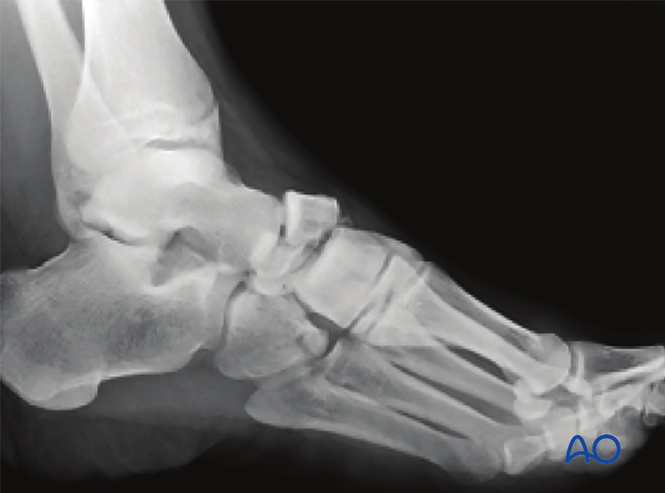 Complete articular navicular fracture