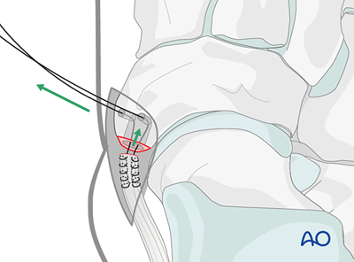 Reattachment of tibialis posterior tendon using suture anchors