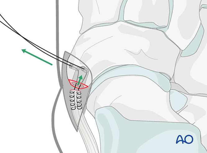 Reattachment of tibialis posterior tendon using suture anchors