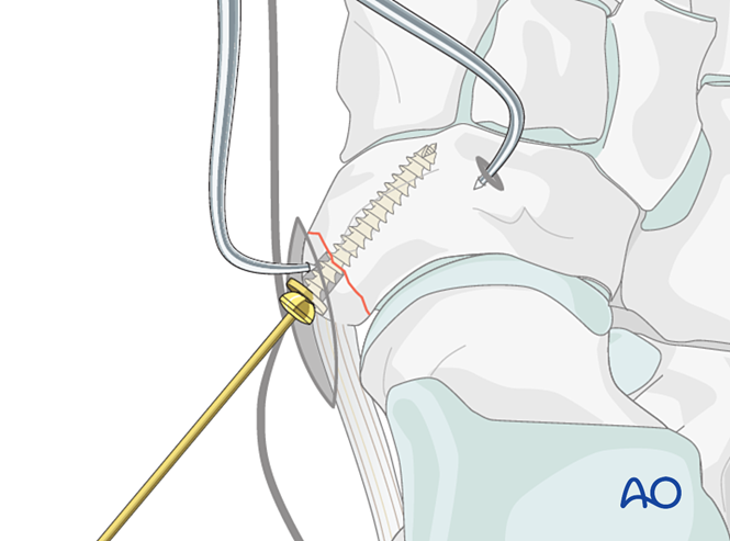 Lag screw fixation of navicular avulsion fracture