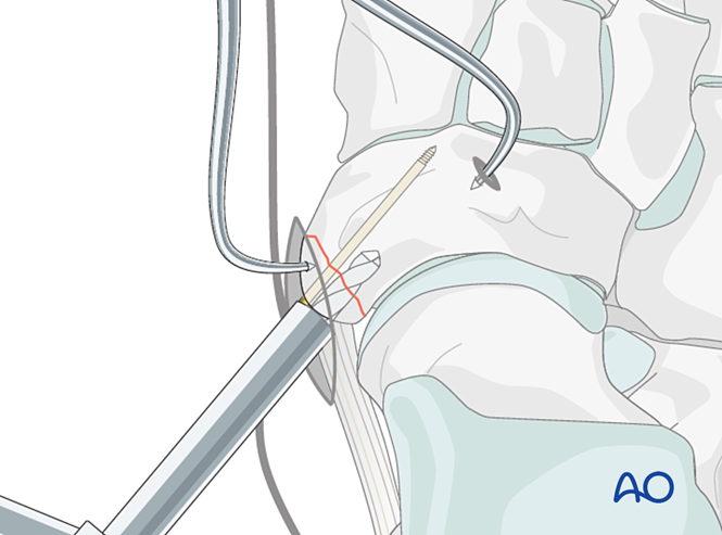 Lag-screw fixation for Navicular avulsion fracture