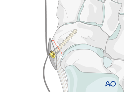 Lag-screw fixation for Navicular avulsion fracture