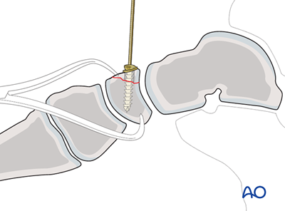 Lag-screw fixation for Partial articular navicular fracture