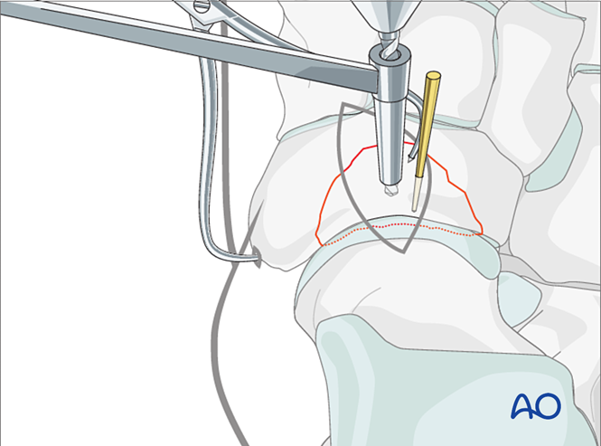 Lag-screw fixation for Partial articular navicular fracture