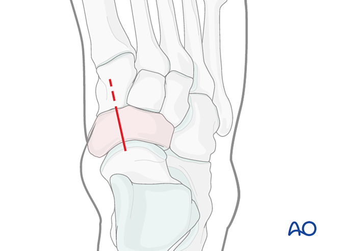 Primary fusion of naviculocuneiform joint for Complete articular ...