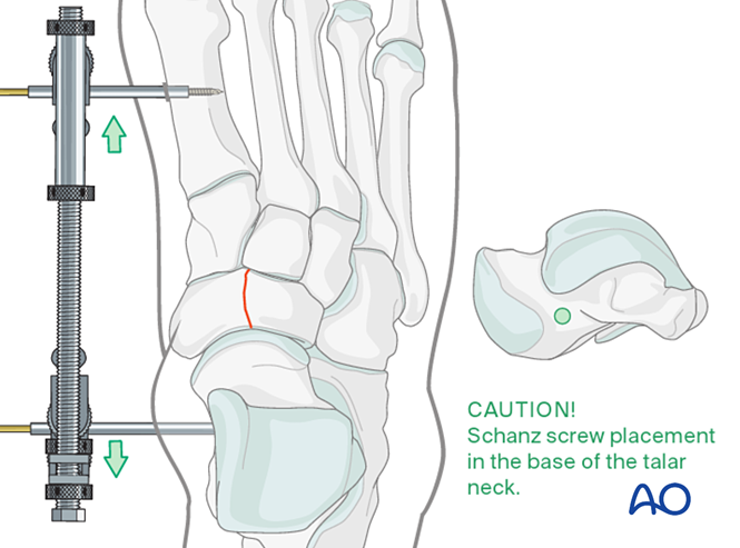 Lag-screw fixation for Complete articular navicular fracture