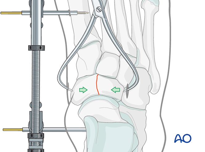 Lag-screw fixation for Complete articular navicular fracture