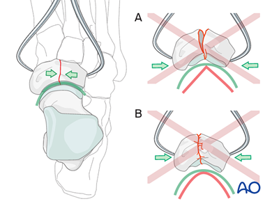 Lag-screw fixation for Complete articular navicular fracture