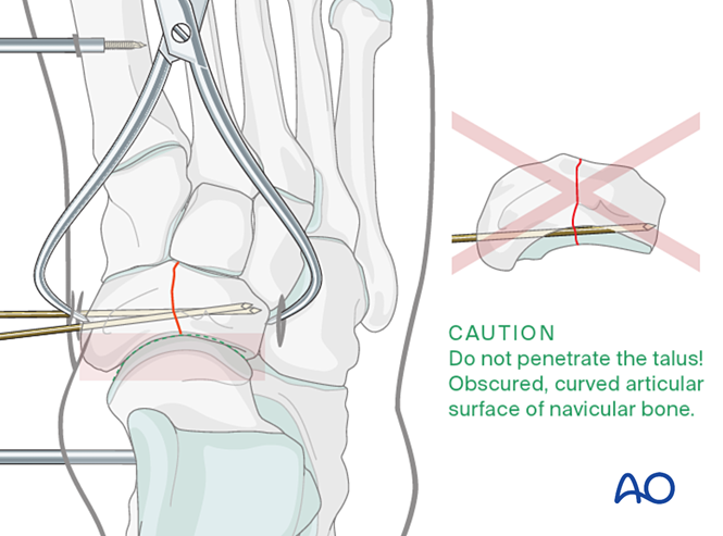 Lag screw of simple complete navicular fracture