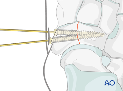 Treatment of Chopart injuries for Chopart injuries