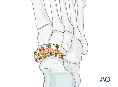 ORIF - Navicular plate for Complete articular navicular fracture