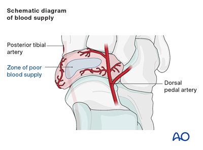 Primary fusion of naviculocuneiform joint for Complete articular ...