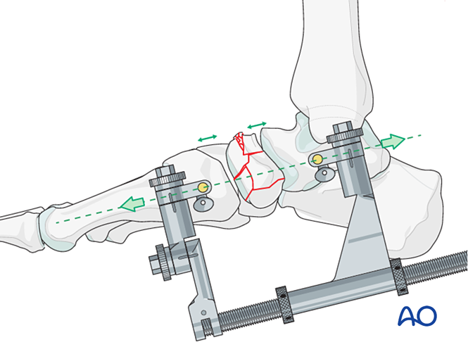 ORIF of navicular with reconstructable articular surfaces